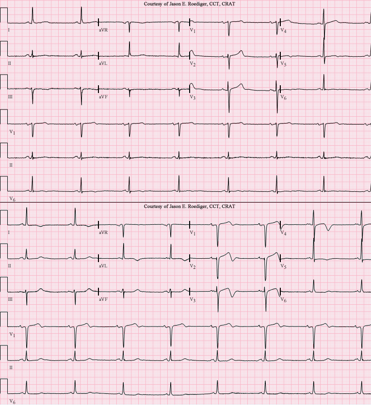 File:Wellens' warning.png - ECGpedia