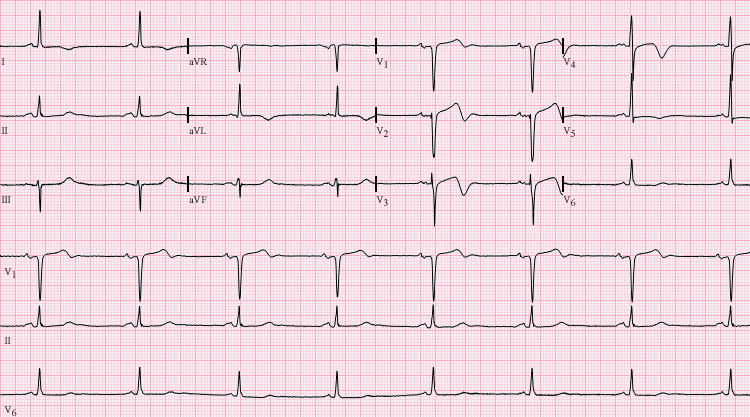 File:Wellens.png - ECGpedia
