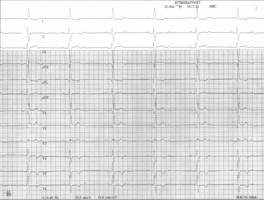 File:Puzzle 2004 6 302 fig1.jpg - ECGpedia