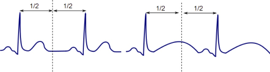 File:QTeyeballing.png - ECGpedia
