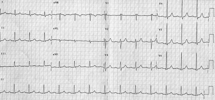 File:Puzzle 2006 11 393 fig2.jpg - ECGpedia