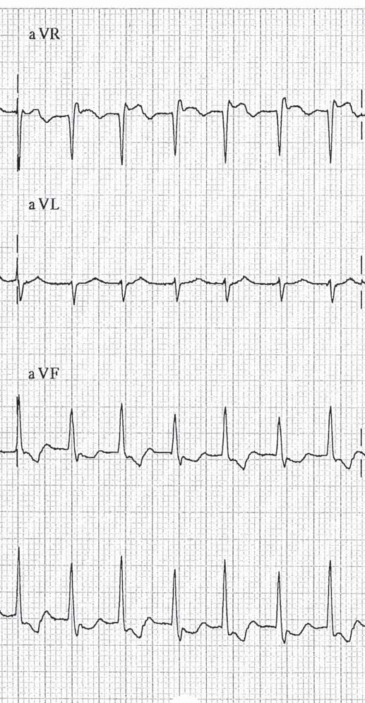 File:Puzzle 2006 11 393 fig2.jpg - ECGpedia