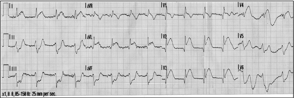 File:Puzzle 2008 04 014 fig2.png - ECGpedia