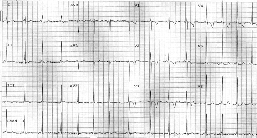 File:Puzzle 2007 5 198 fig1.jpg - ECGpedia